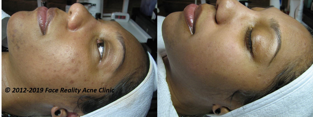What is the Difference between Acne Scars And Dark Spots: Clear Skin ...